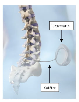 Bomba de blacofeno intratecal