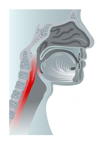 Deglución en pacientes con síndrome de vigilia sin respuesta
