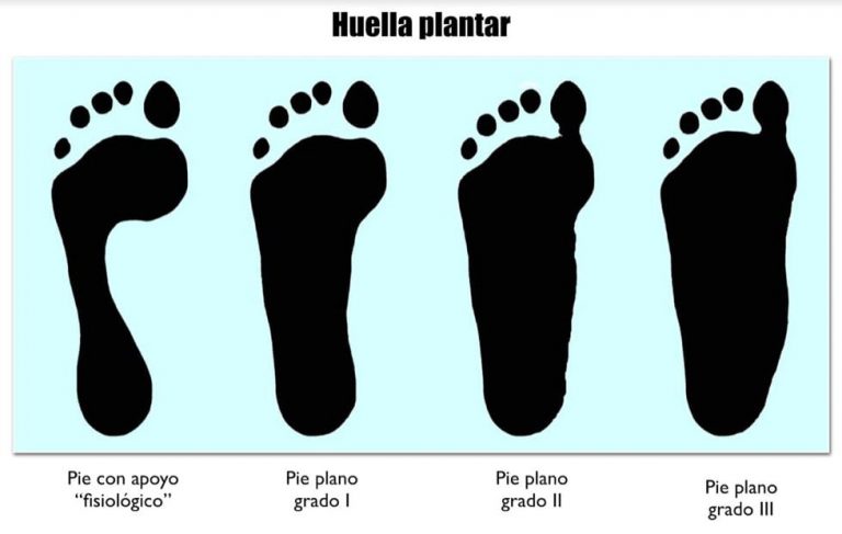 Ejercicios para niños con pie plano y afectación neurológica